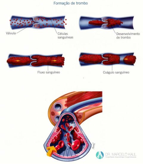 Trombose Venosa Profunda - Marcelo Kalil